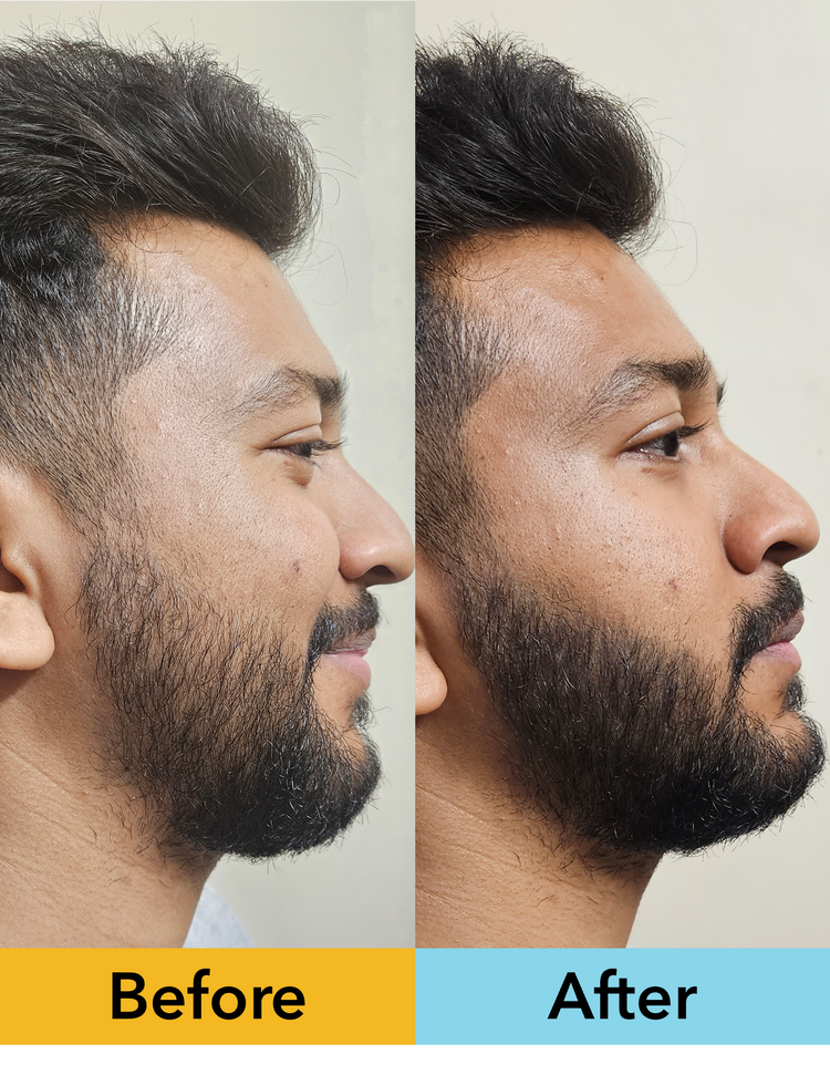 Patchy Beard Fix – Instant Solution for Beards – Rise for Men