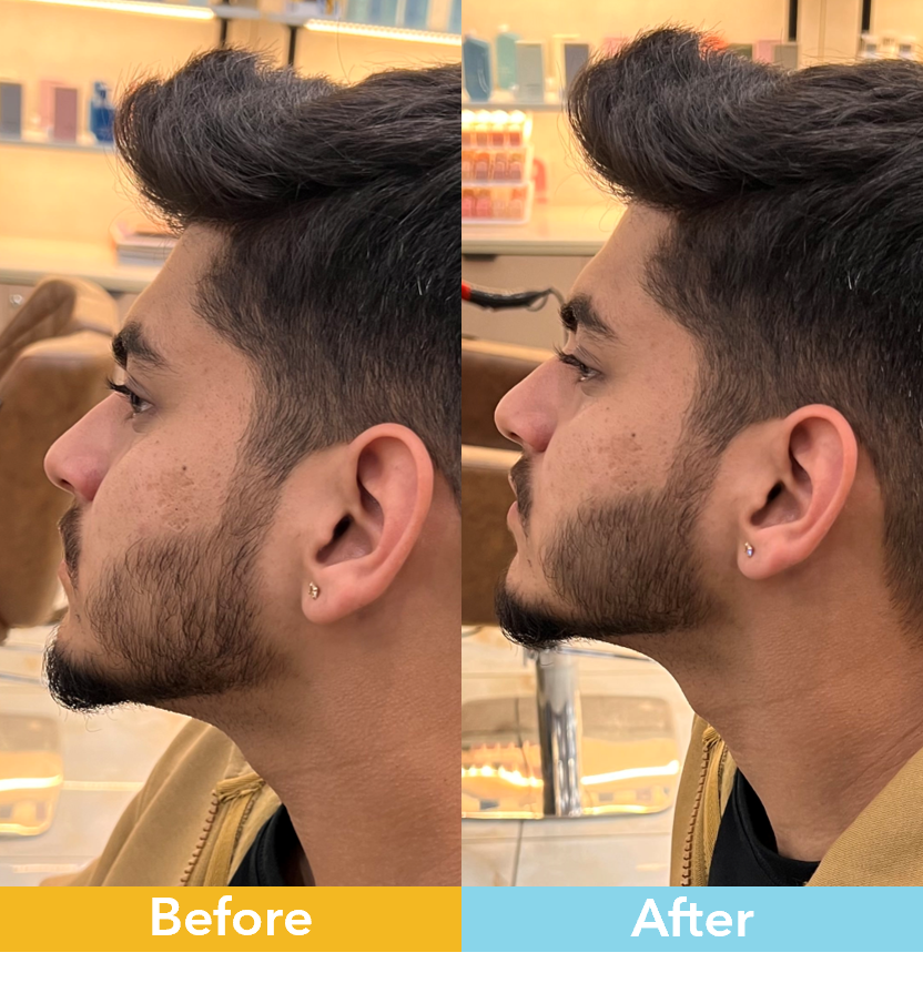 Patchy Beard Fix – Instant Solution for Beards – Rise for Men